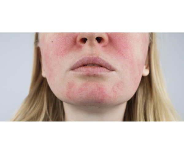 Mar 15, 2024 creams for acne prone skin